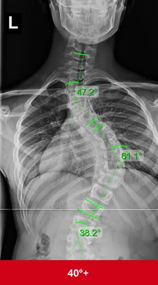 Severe Scoliosis - Symptoms, Treatment, and Surgery