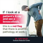 What is Levoconvex Lumbar Scoliosis?