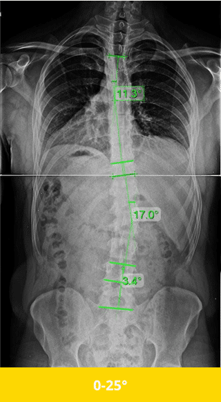 Mild Scoliosis - Symptoms, Treatment, and Surgery Mild Scoliosis - Symptoms, Treatment, and Surgery