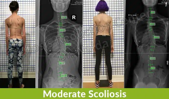 Moderate Scoliosis