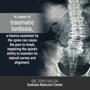 Thoracic Lordosis: What Is Lordosis? Treatment Options