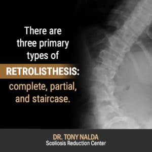 Retrolisthesis: Types, Symptoms, Causes, and Treatment
