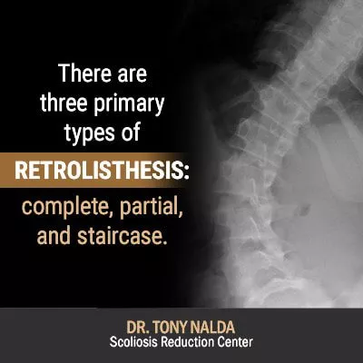 Retrolisthesis C3 C4