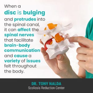 Bulging Disc Treatment: How To Treat Bulging Discs