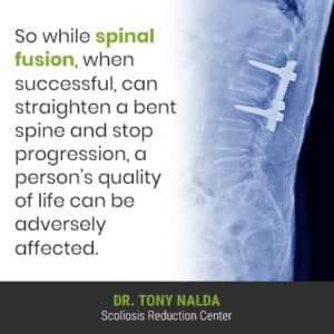 Scoliosis Surgery Success Rate & Scoliosis Surgery Alternatives