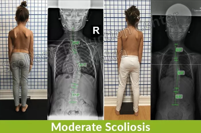 Moderate Scoliosis - Symptoms, Treatment, and Surgery